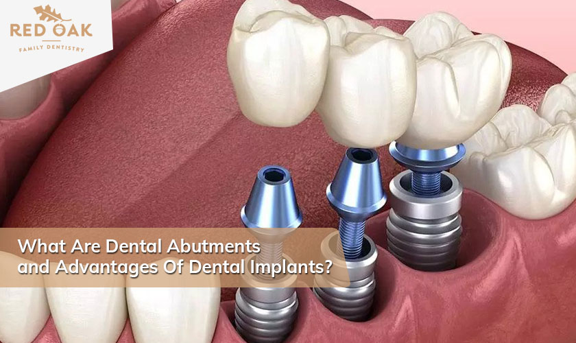 What Are Dental Abutments and Advantages Of Dental Implants?