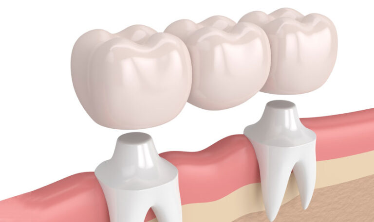 How Can A Dental Crown Protect Your Teeth